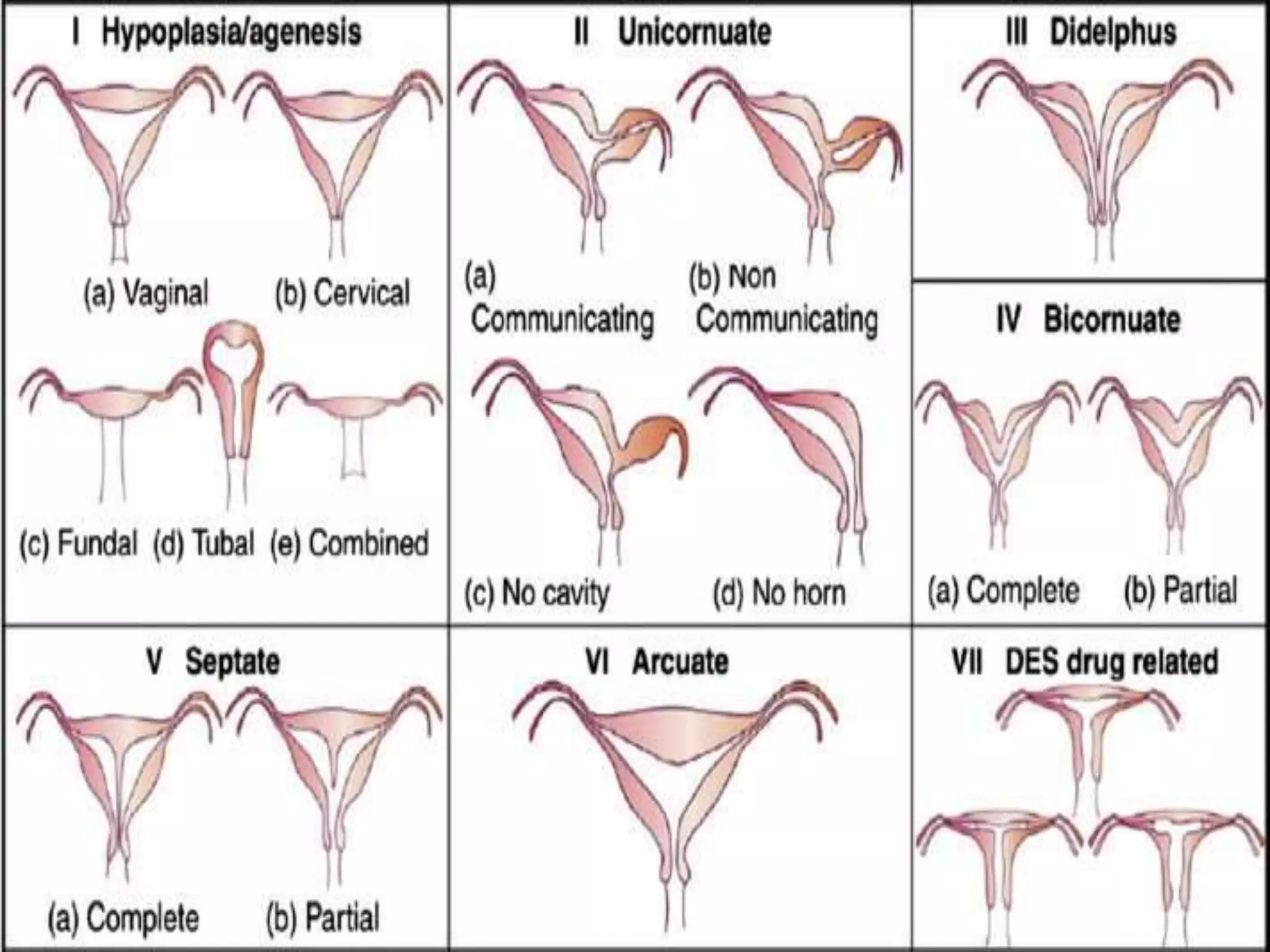 Uterine abnormalities | PPTX
