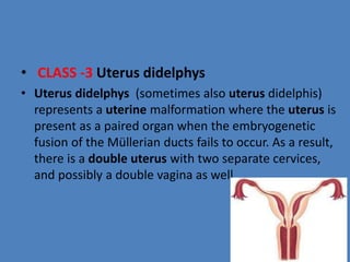 Uterine abnormalities | PPTX