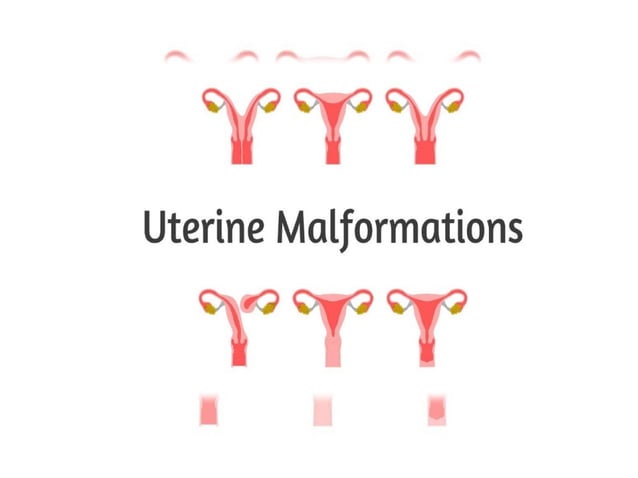 Uterine Abnormalities And Displacement Pptx