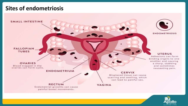 uterine and cervical disorders.pptx