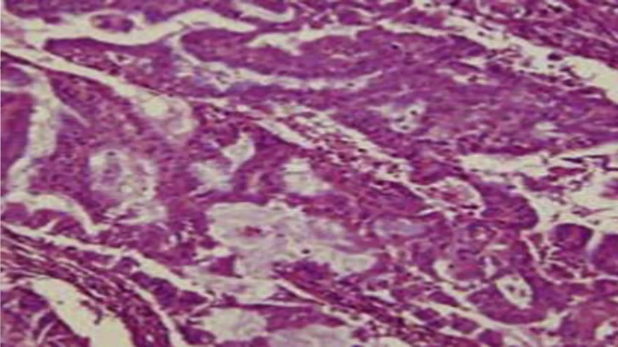 Uterine And Cervix Cancer Pptx
