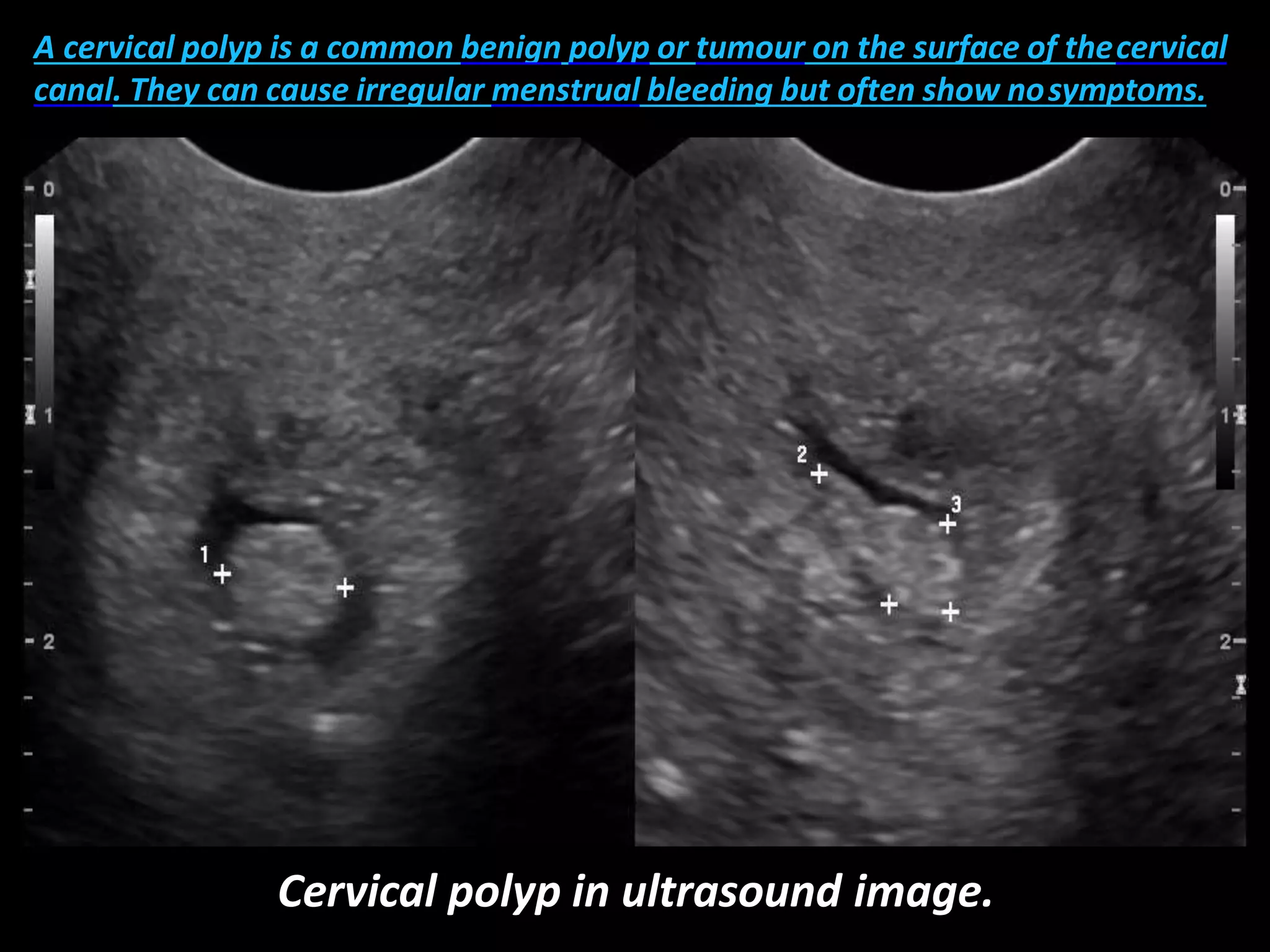 ULTRASOUND EXAMINATION OF Uterine and ovarian pathology by DR ABHIJIT R ...