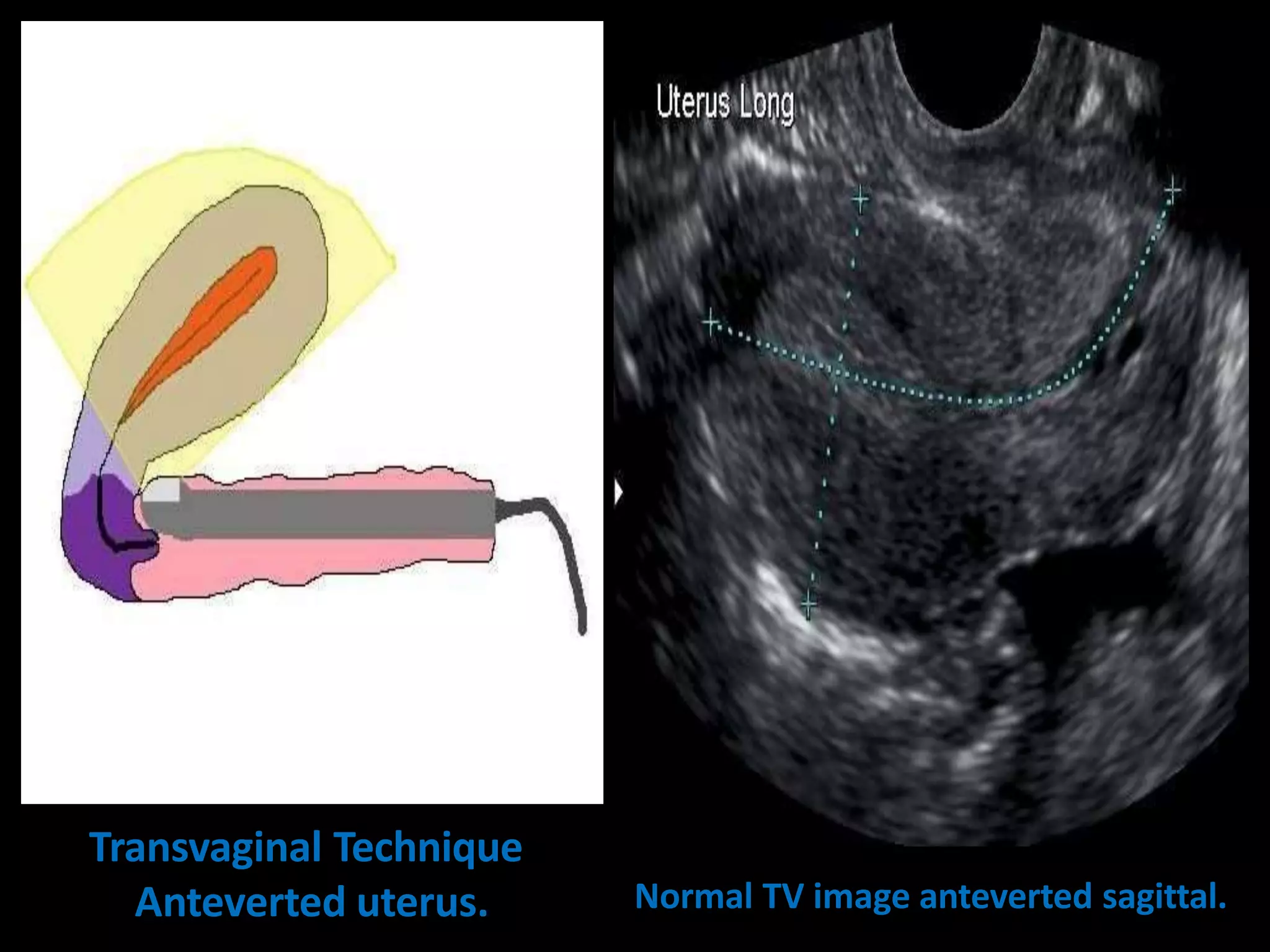 ULTRASOUND EXAMINATION OF Uterine and ovarian pathology by DR ABHIJIT R ...