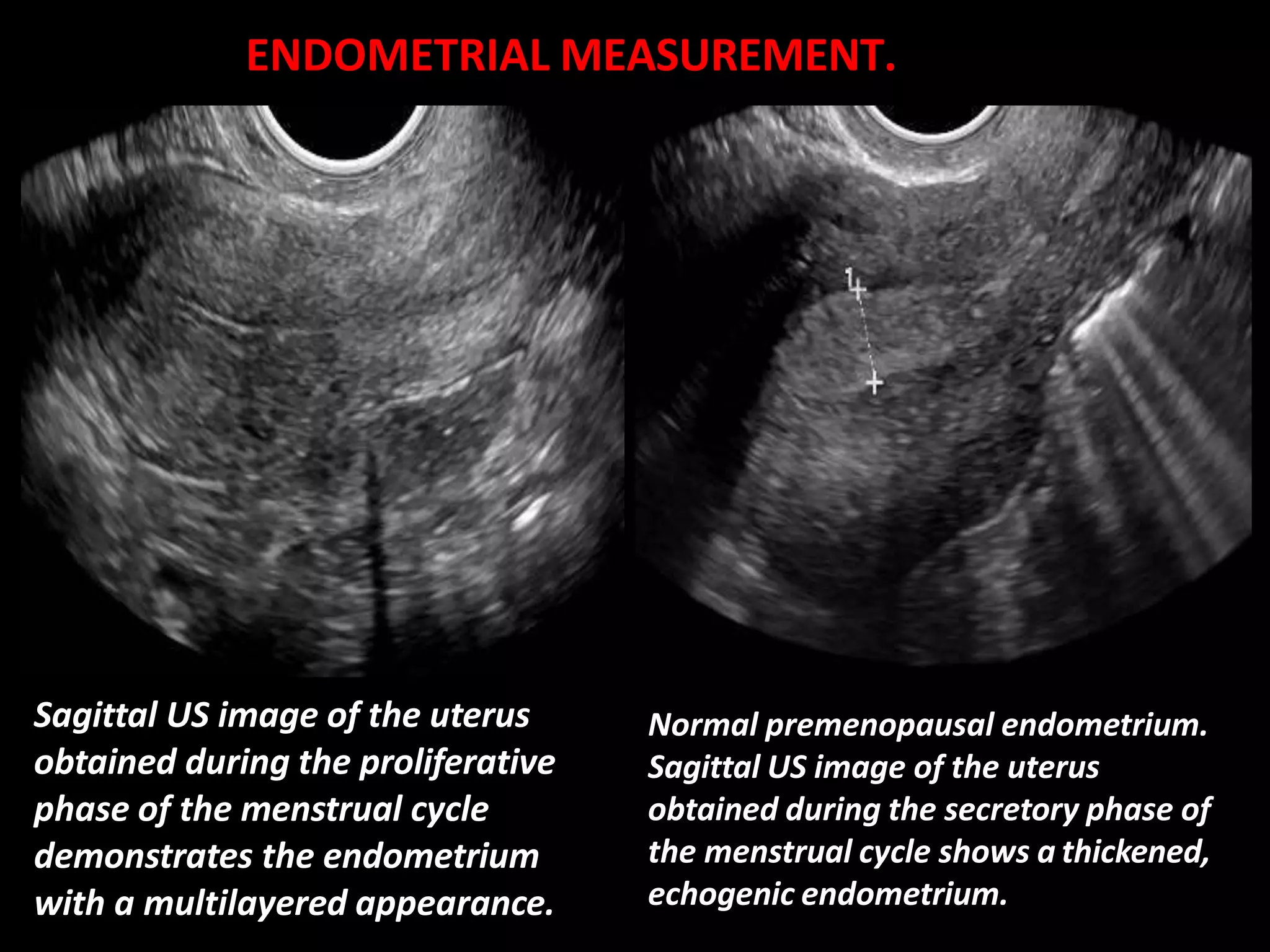 ULTRASOUND EXAMINATION OF Uterine and ovarian pathology by DR ABHIJIT R ...