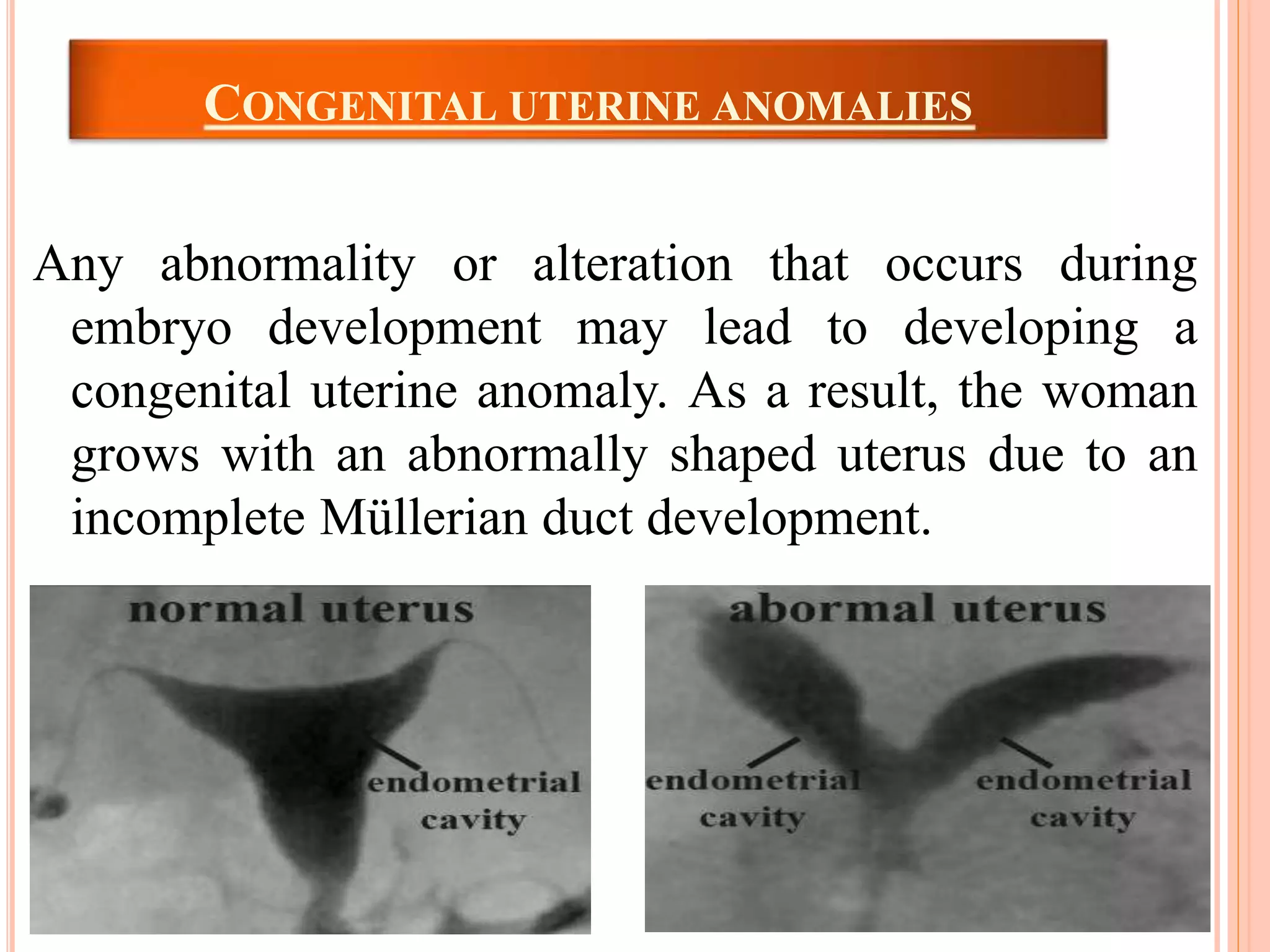 Uterine anomalies | PPTX