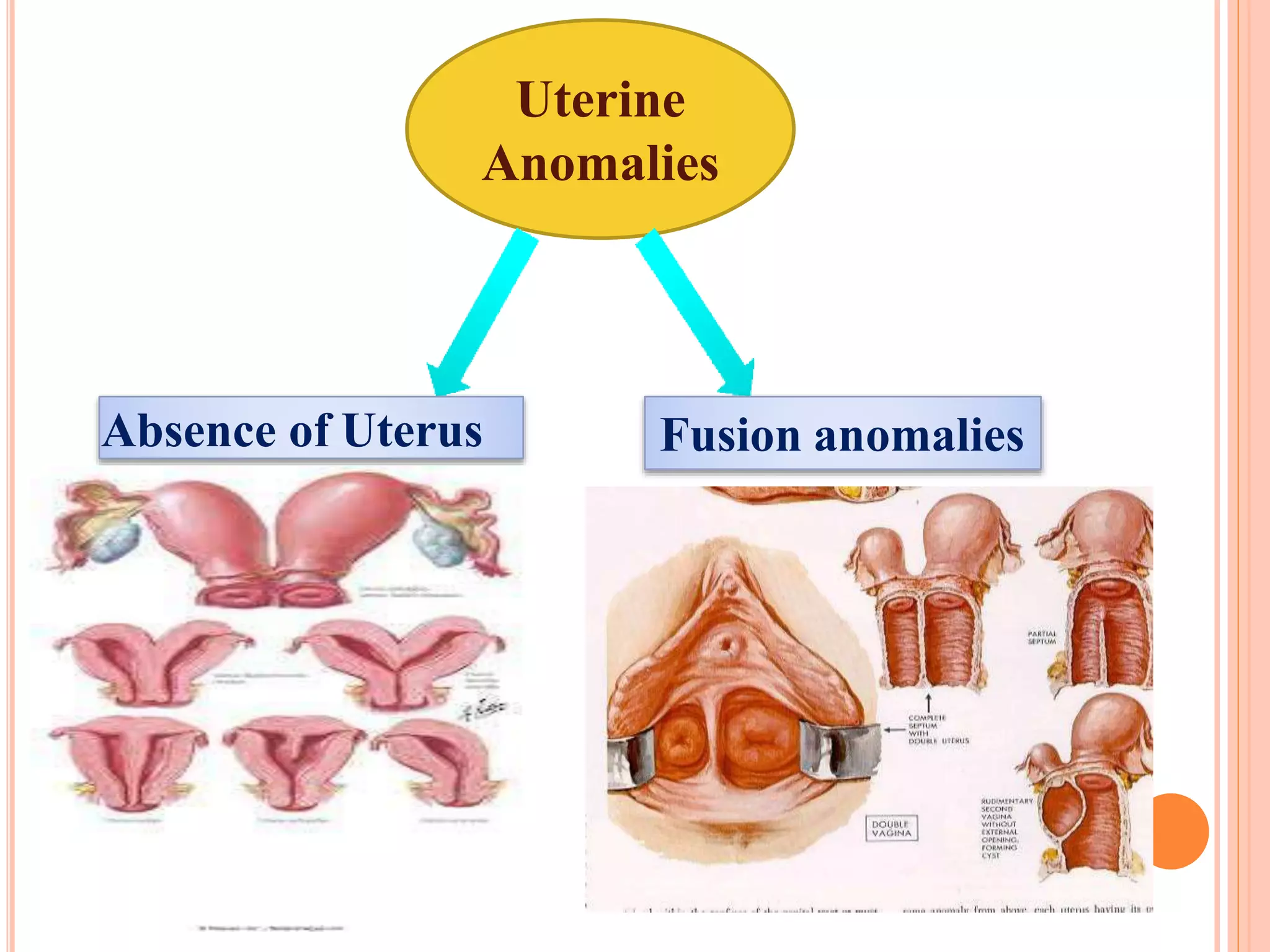 Uterine anomalies | PPTX