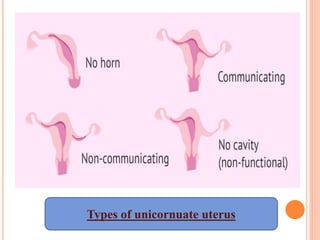 Uterine anomalies | PPTX