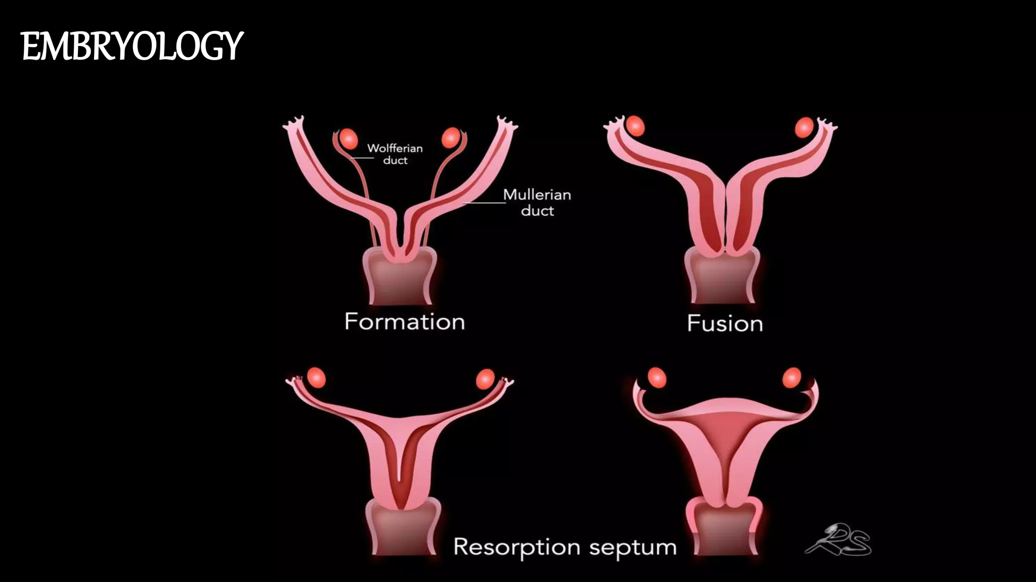 Uterine Anomaly Ub Pptx