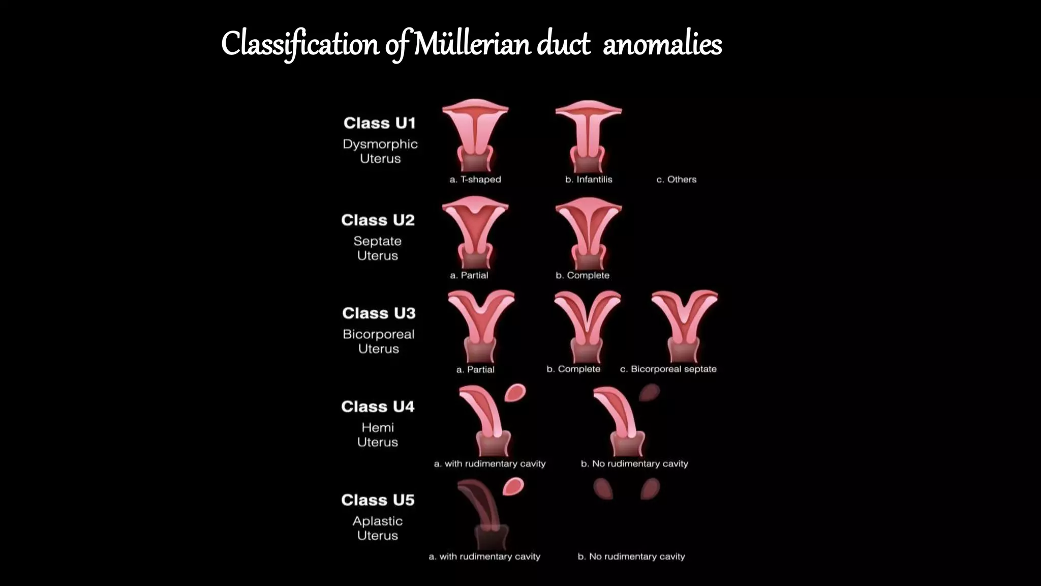 Uterine Anomaly Ub Pptx