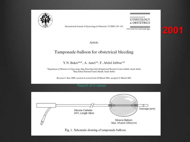 Uterine balloon tamponade in Postpartum Hemorrhage (PPH) | PPT Uterine balloon tamponade in Postpartum Hemorrhage (PPH) | PPT