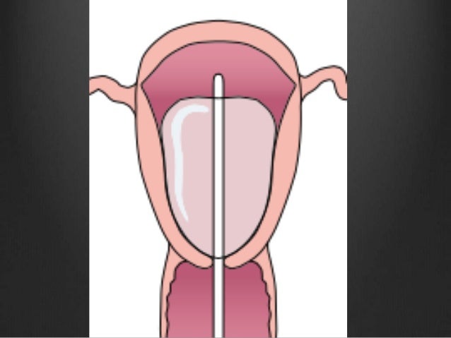 Uterine balloon tamponade in Postpartum Hemorrhage (PPH)