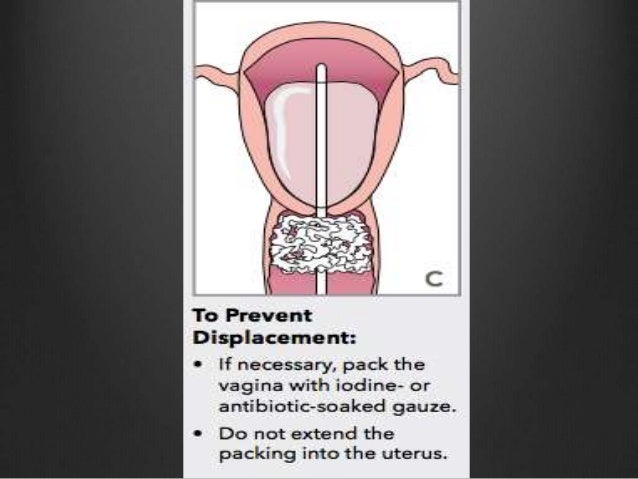 Uterine balloon tamponade in Postpartum Hemorrhage (PPH)