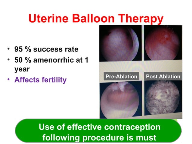 Uterine balloon therapy an alternatives to hysterectomy dr. sharda jain ...