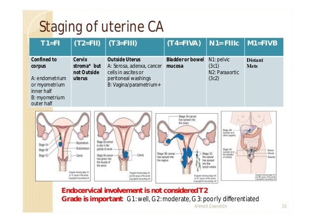 Uterine Cancer 10 2011