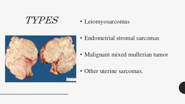 Uterine Sarcoma