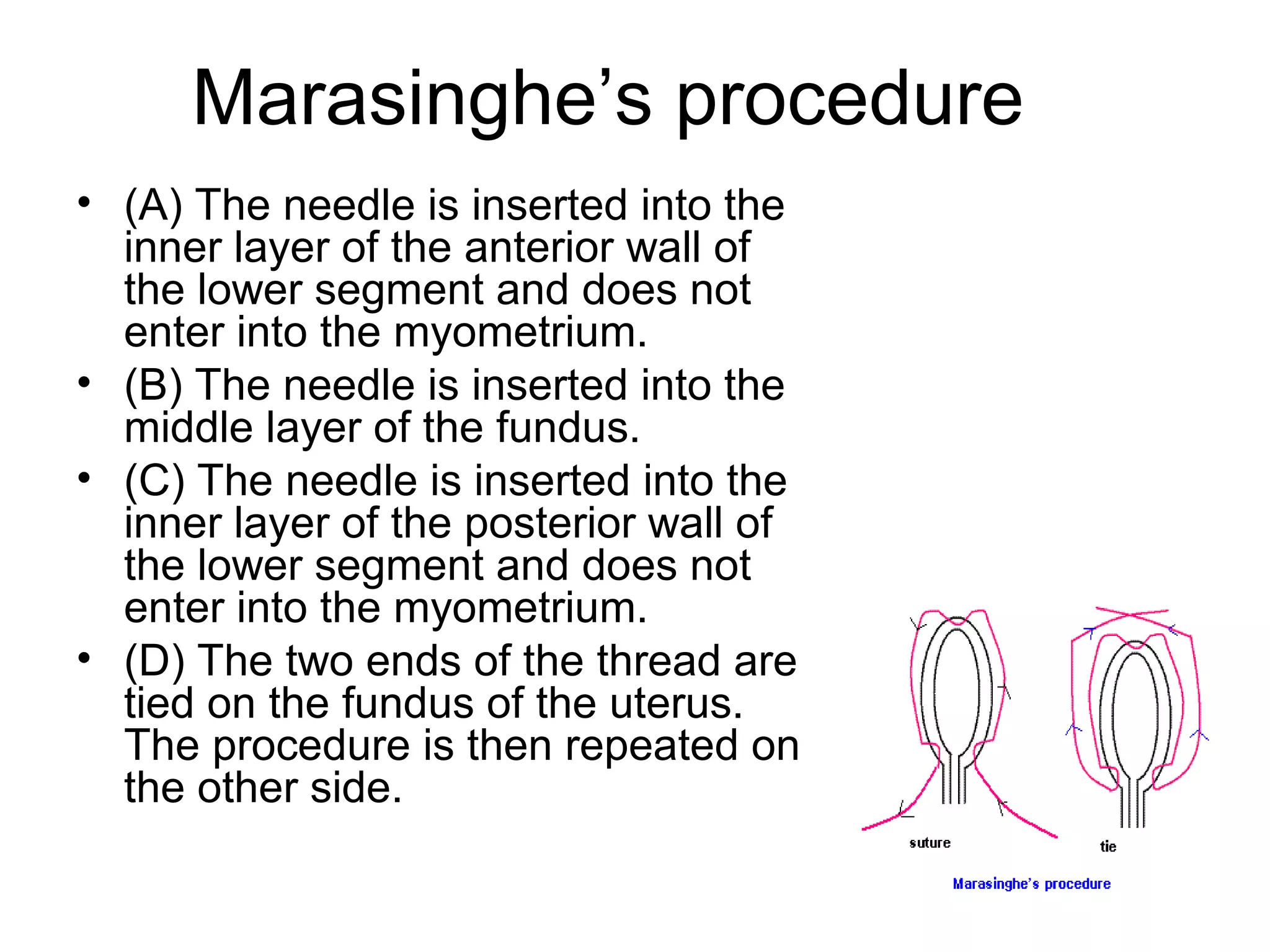 Uterine compression sutures | PPT