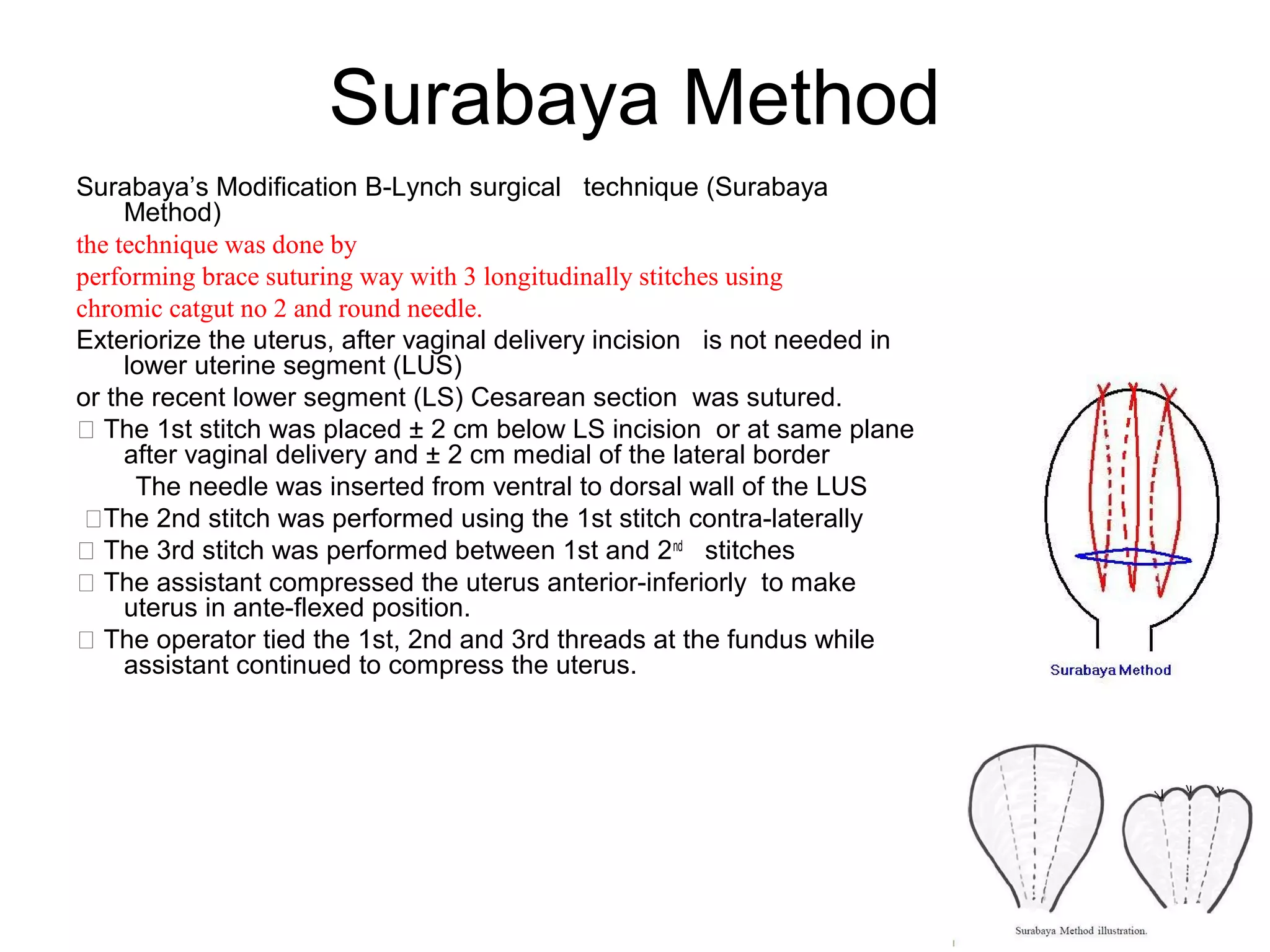 Uterine compression sutures | PPT