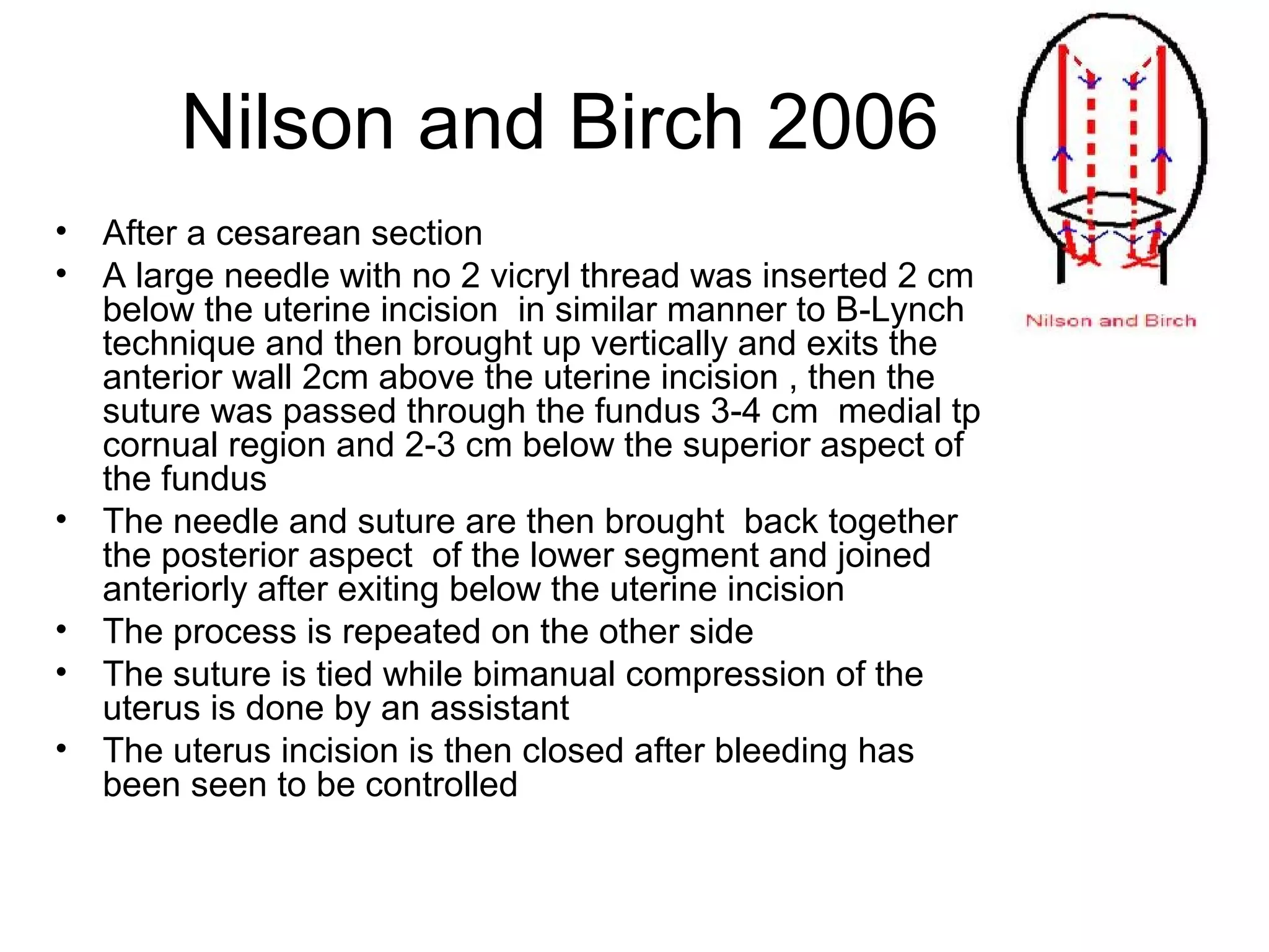 Uterine compression sutures | PPT