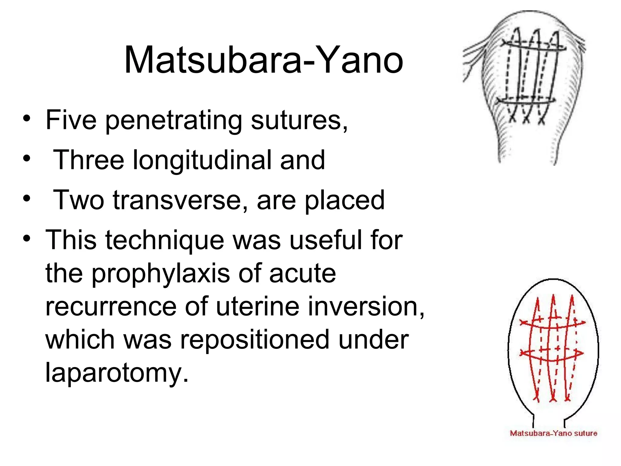 Uterine compression sutures | PPT