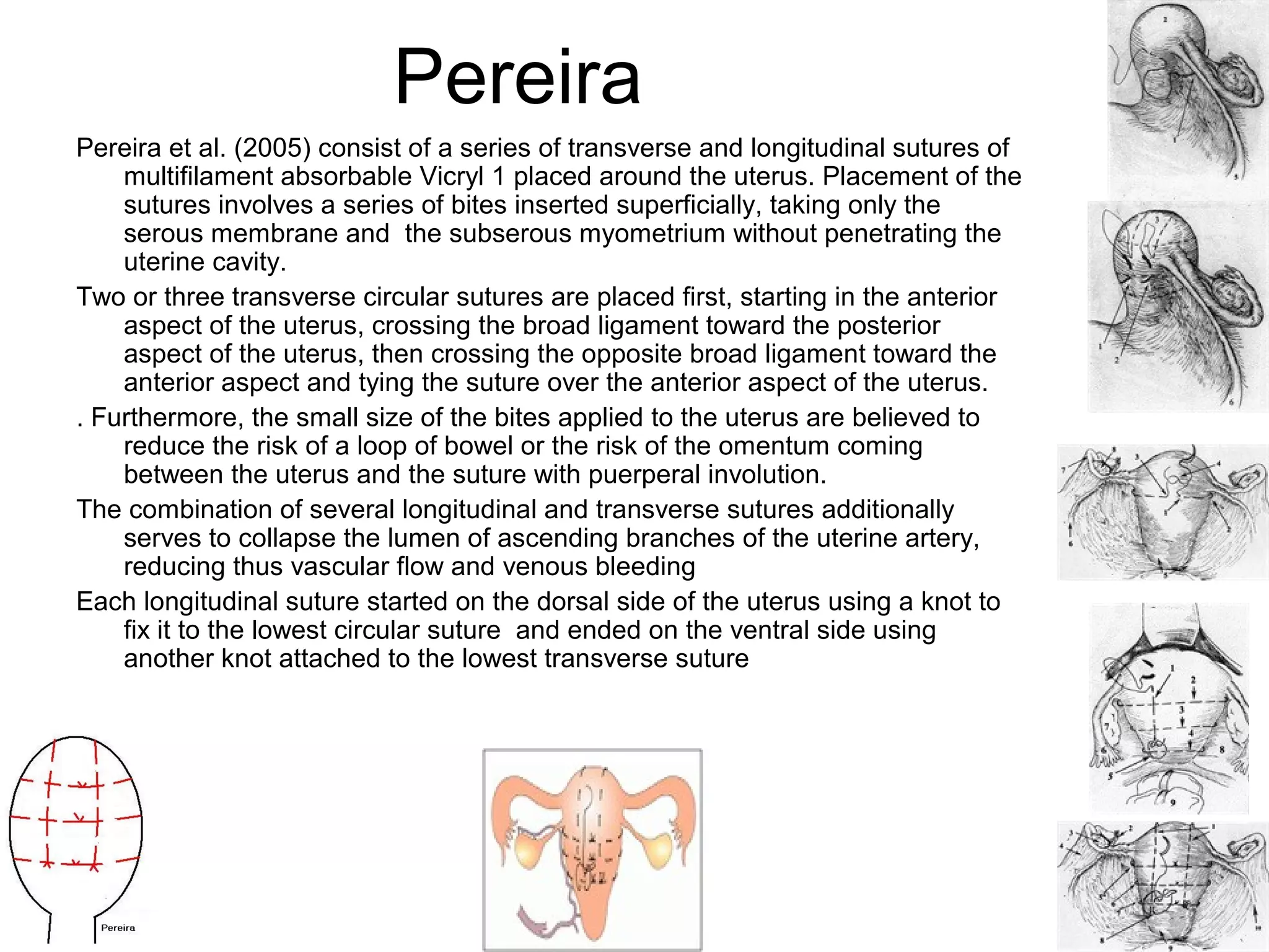 Uterine compression sutures | PPT