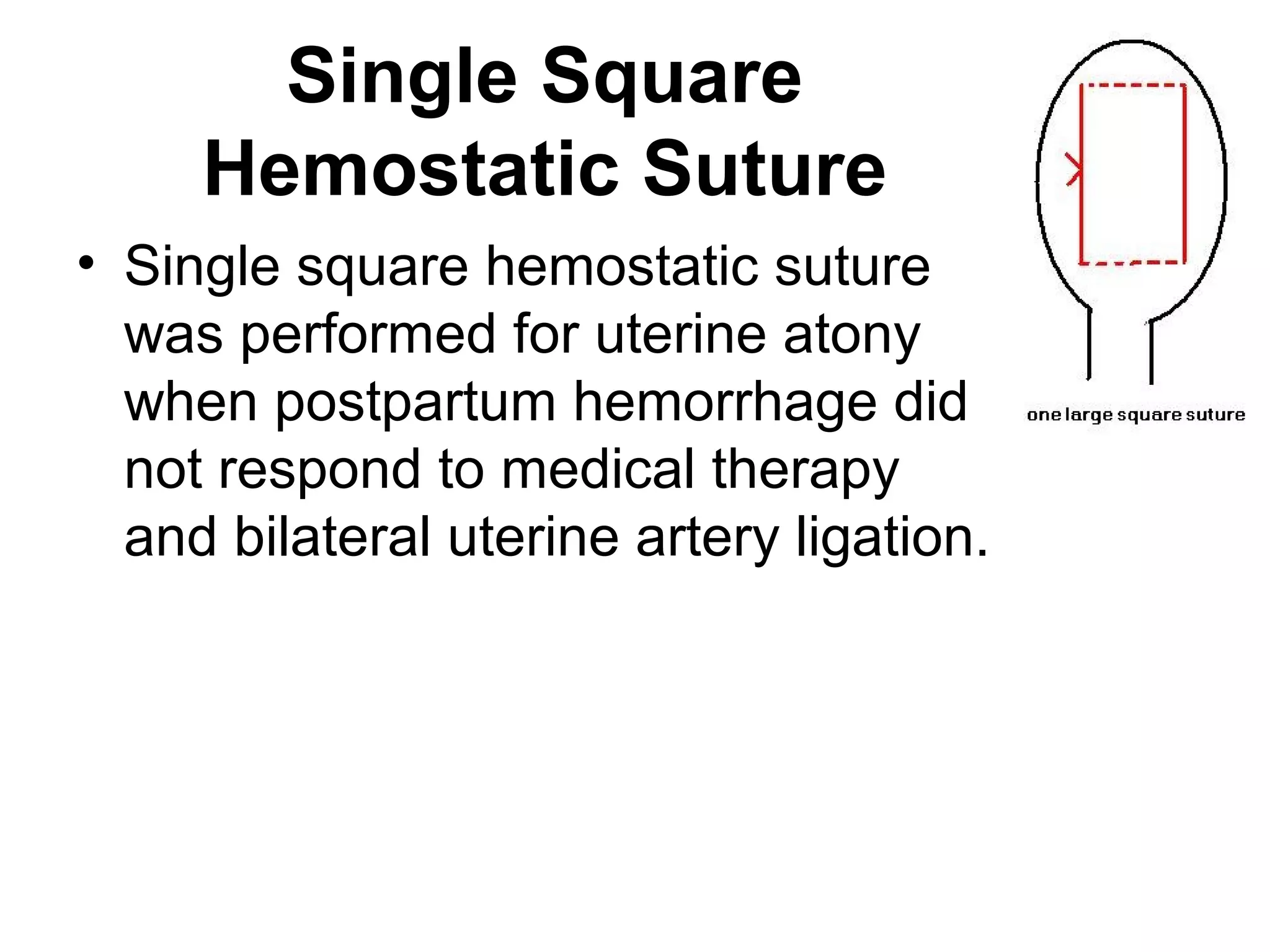 Uterine compression sutures | PPT