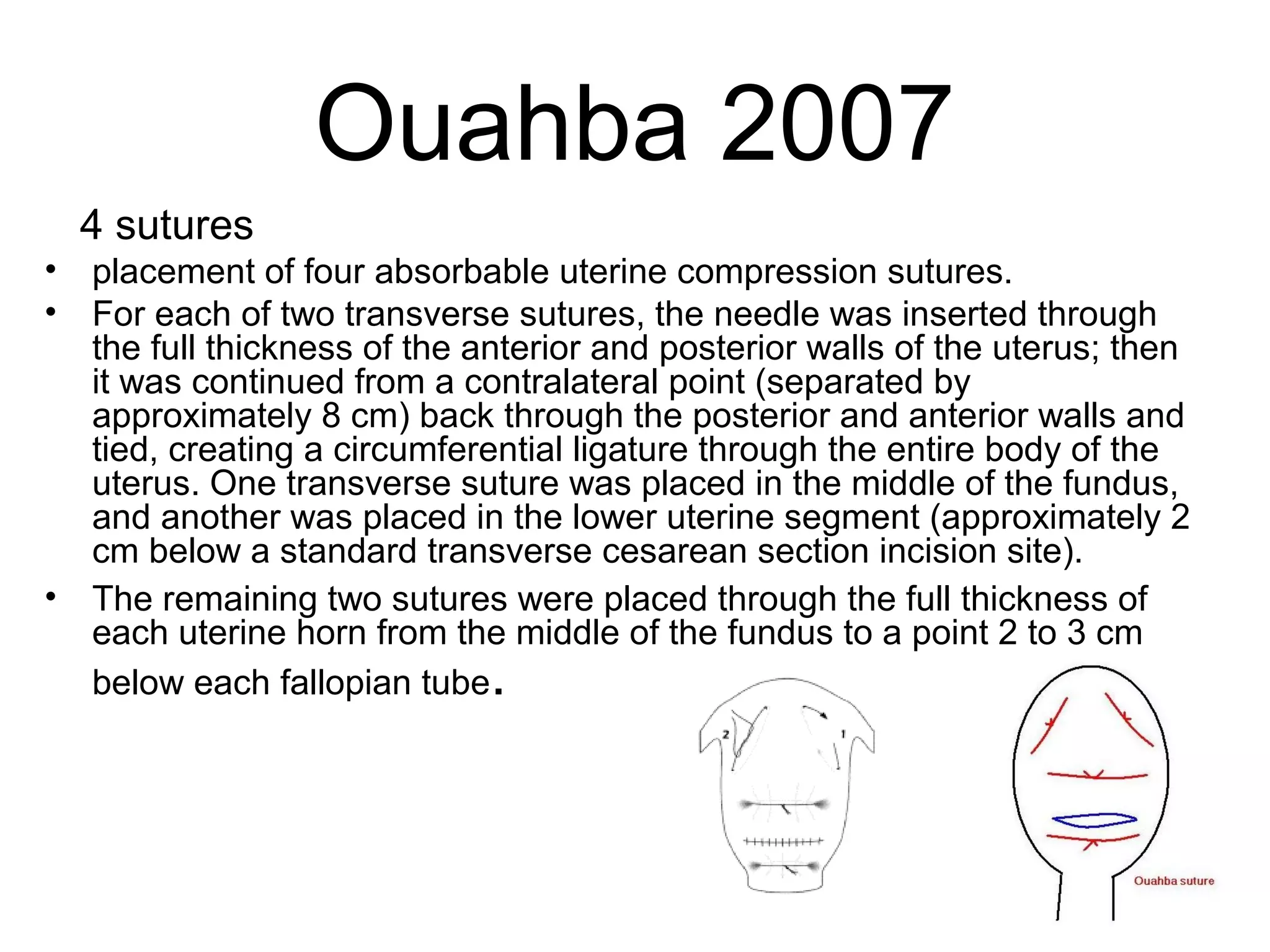 Uterine compression sutures | PPT