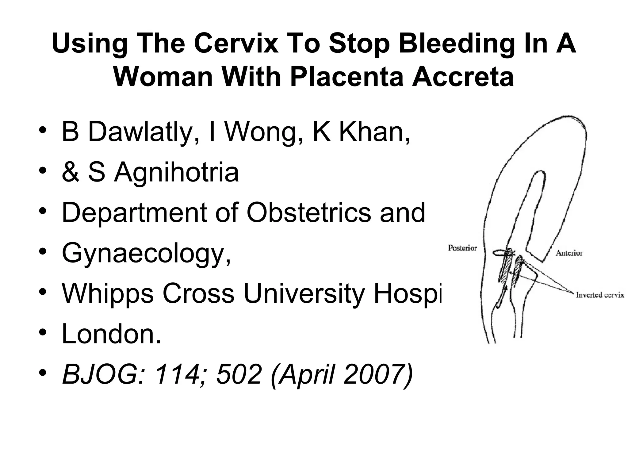 Uterine compression sutures | PPT