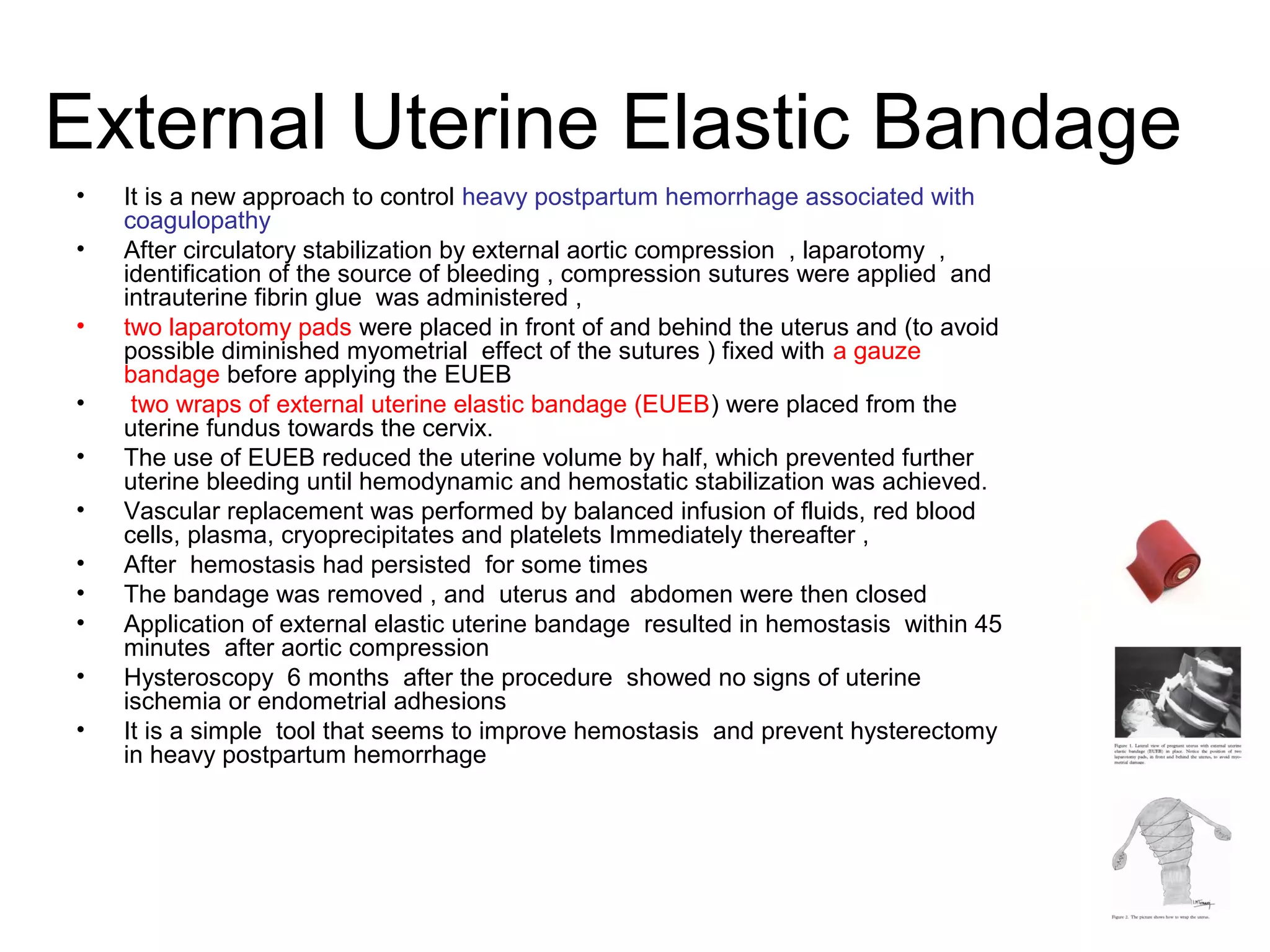 Uterine compression sutures | PPT