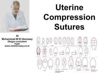 Uterine compression sutures | PPT
