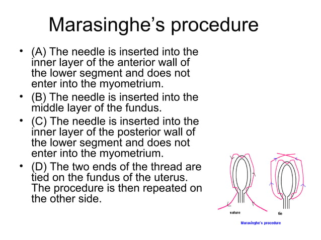 Uterine compression sutures | PPT
