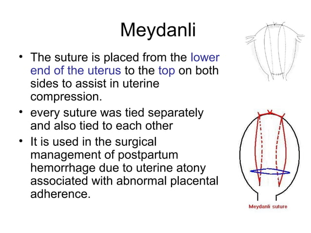 Uterine compression sutures | PPT