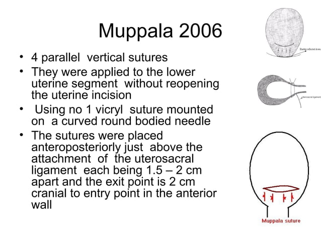 Uterine compression sutures | PPT