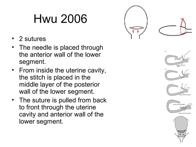 Uterine compression sutures | PPT