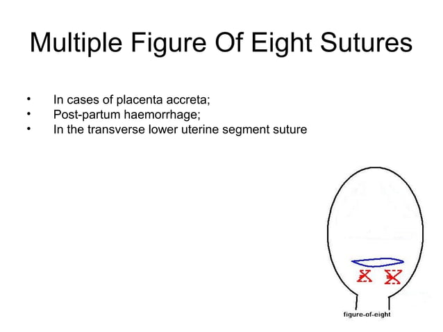 Uterine compression sutures | PPT