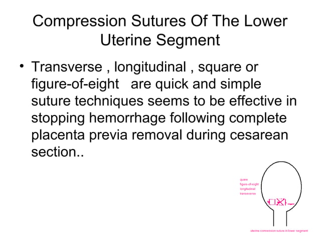 Uterine compression sutures | PPT