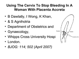 Uterine compression sutures | PPT
