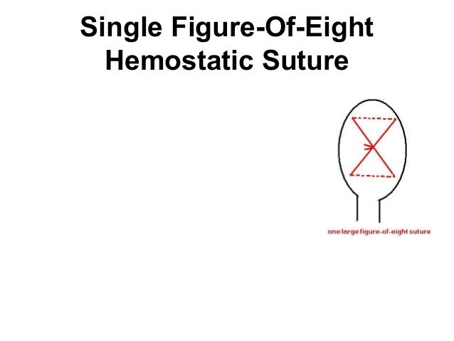 Uterine compression sutures