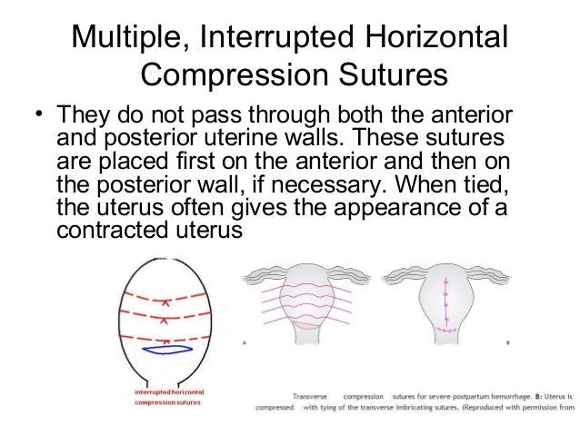 Uterine compression sutures