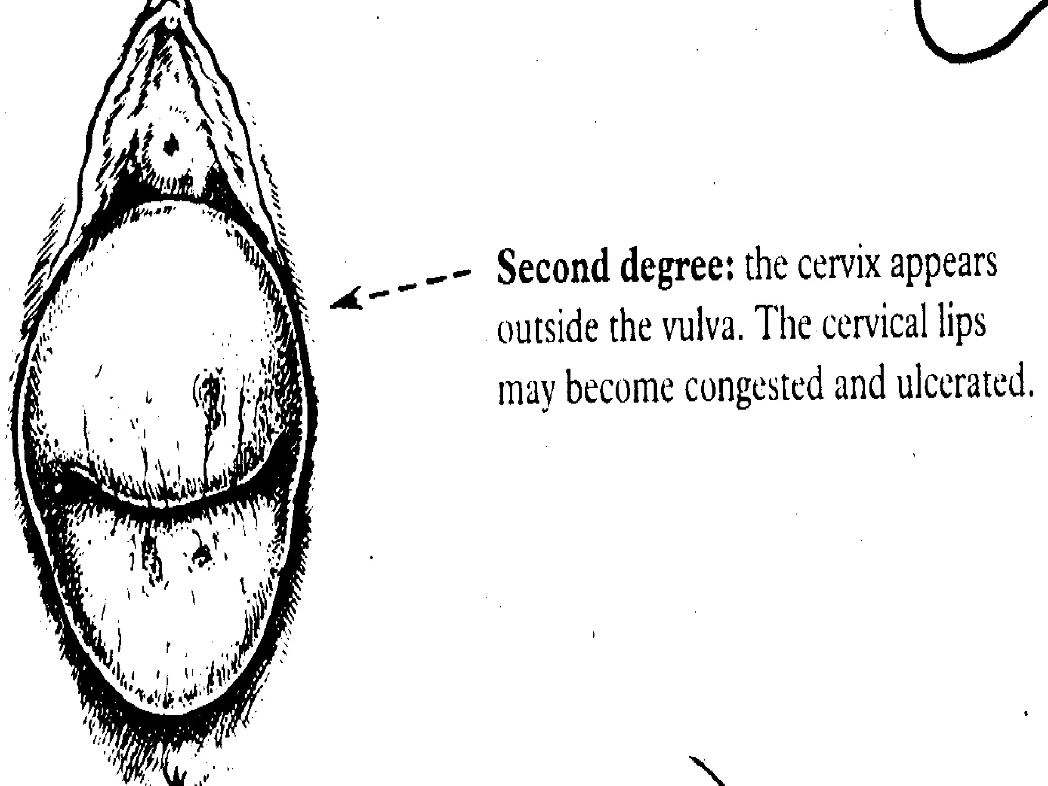 UTERINE DISPLACEMENT.pptx