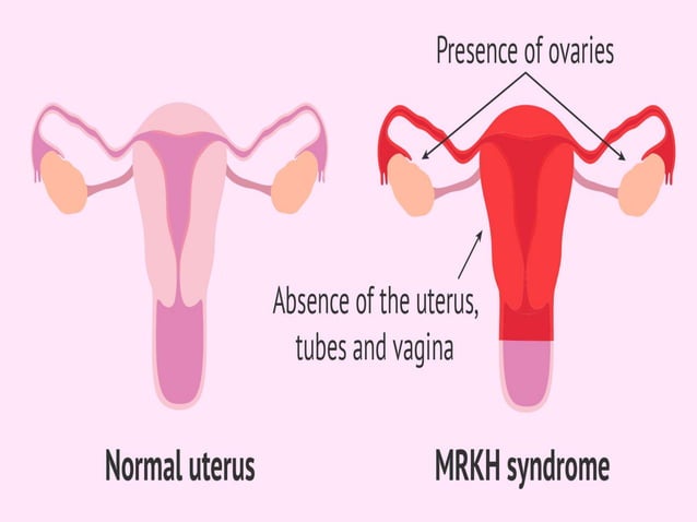 uterine factor of infertility, | PPTX | Infertility | Reproductive Health