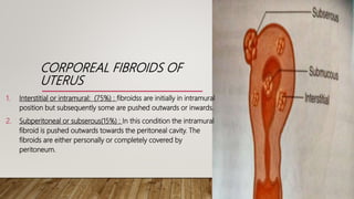 Uterine fibroid | PPTX