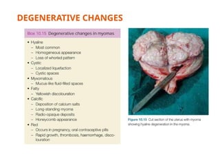 Uterine fibroid obstetrics and gynecology.pptx
