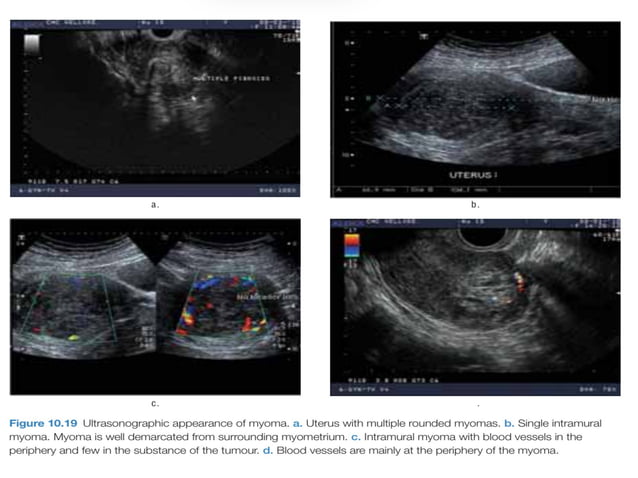 Uterine fibroid obstetrics and gynecology.pptx | Pregnancy | Reproductive Health