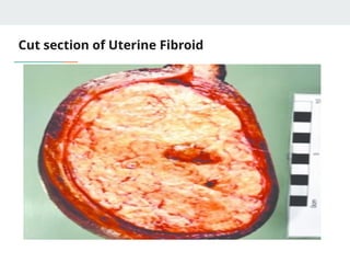 Uterine fibroid obstetrics and gynecology.pptx