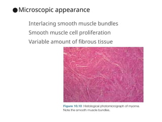 Uterine fibroid obstetrics and gynecology.pptx