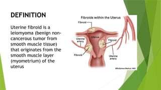 uterine fibroid.presentation of streerog department | PPTX