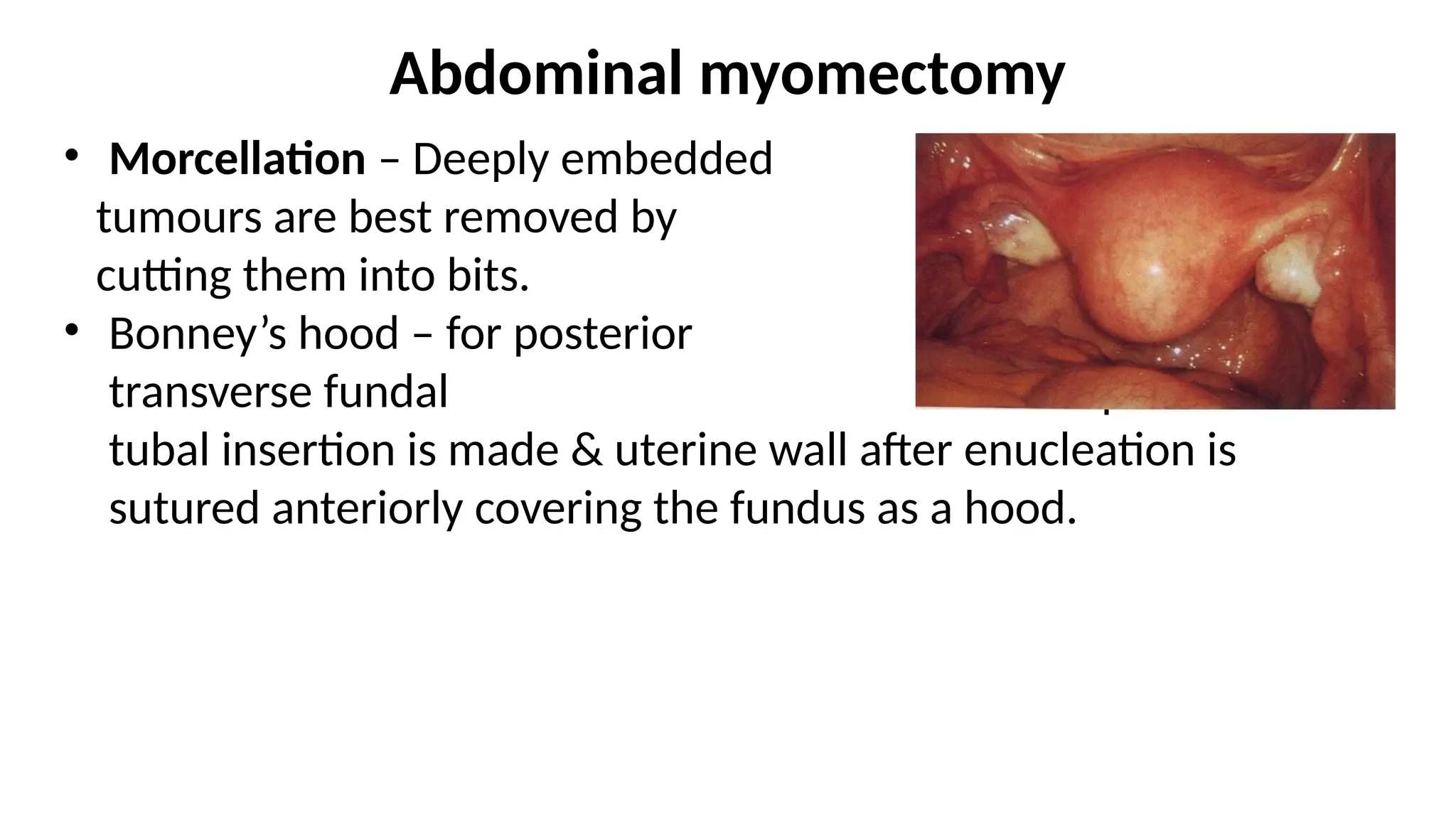 Uterine Fibroid Presentation for ONGpptx | PPTX