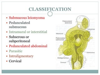 Uterine fibroid (leiomyoma) and new treatment modalities | PDF