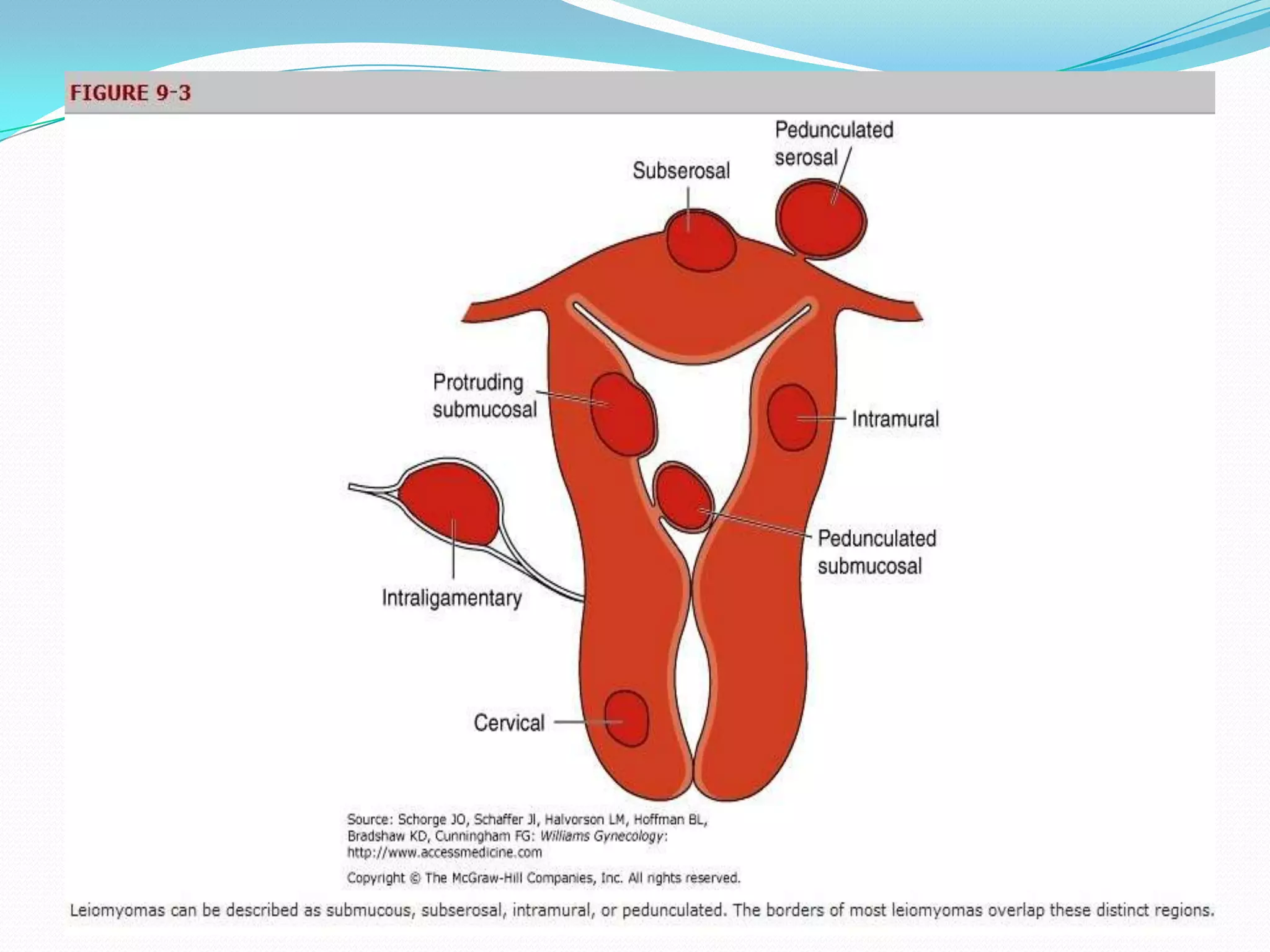Uterine Fibroids Ppt