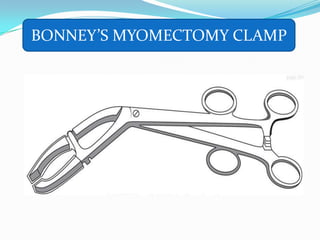 Uterine fibroids | PPTX